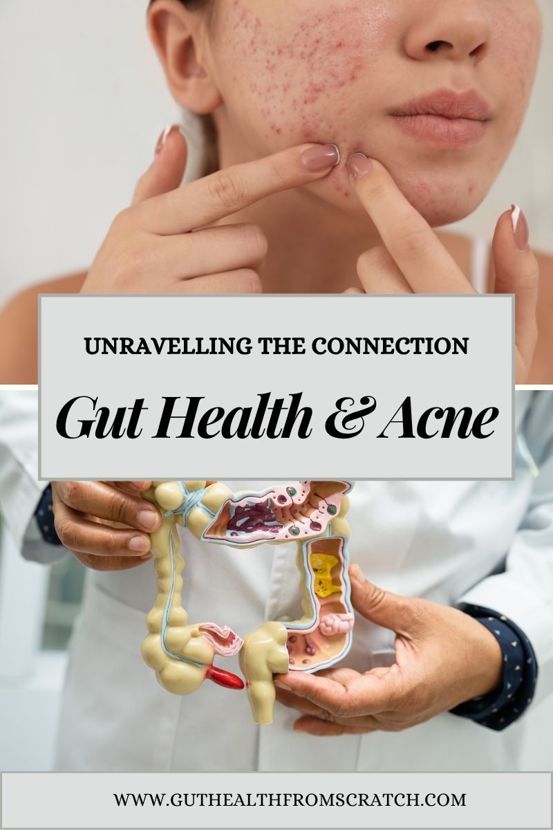 Unravelling the Connection Between Acne and Gut Health - Gut Health ...